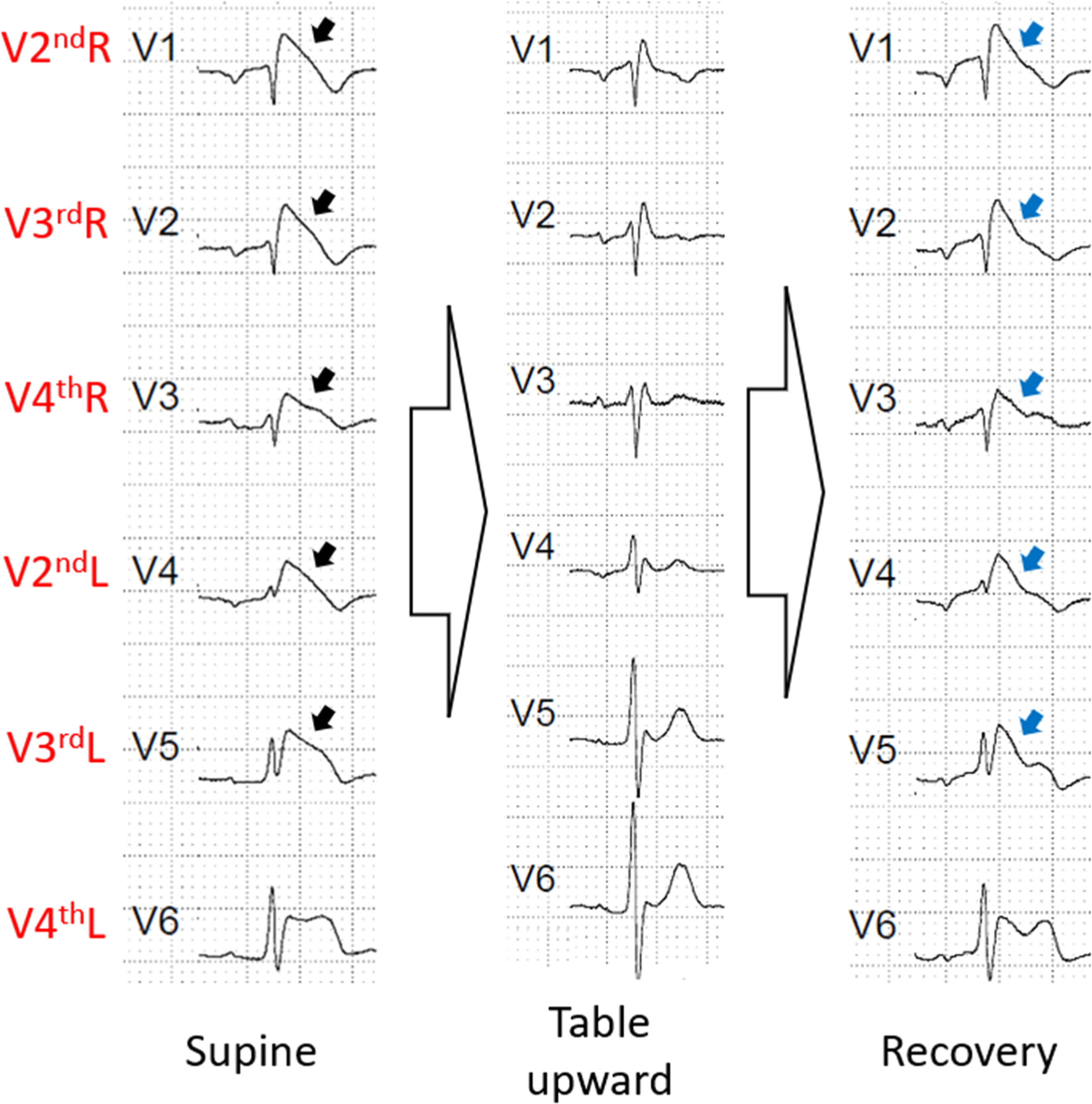 Brugada pattern changes during tilt table test with high precordial ...