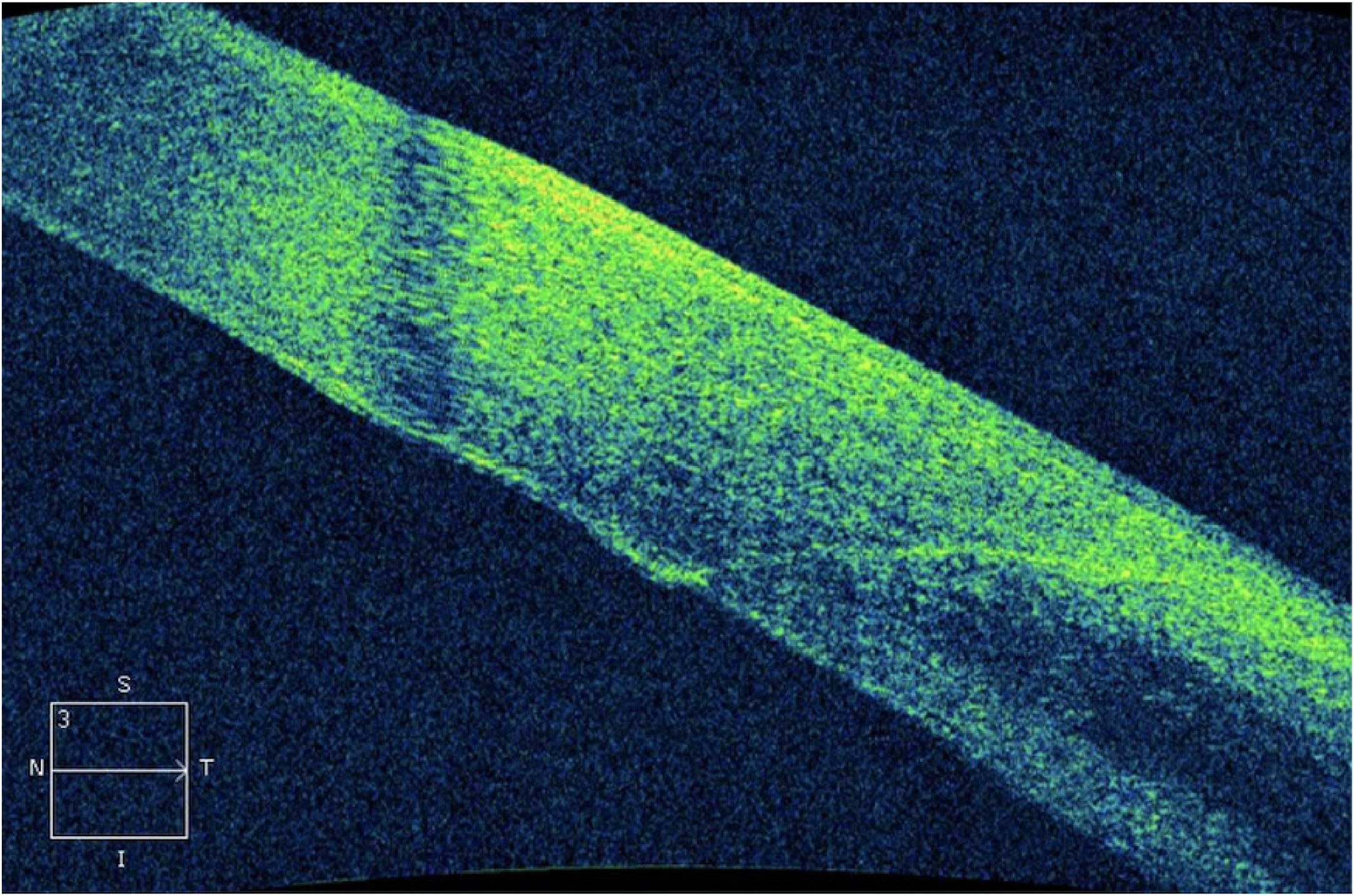 Evaluation of corneal incision in femtosecond laser-assisted ...
