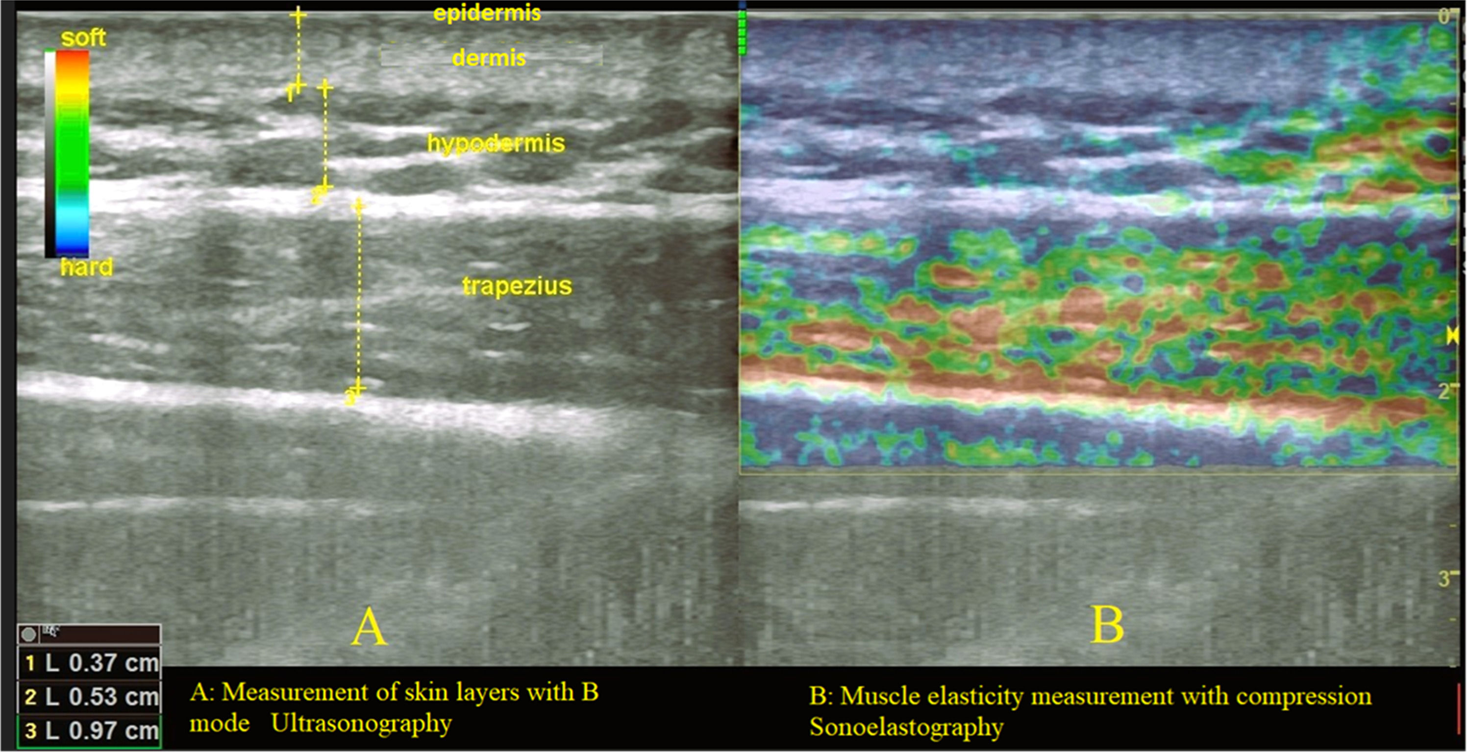 Skin layer thickness, muscle elasticity and their effects on pain level ...