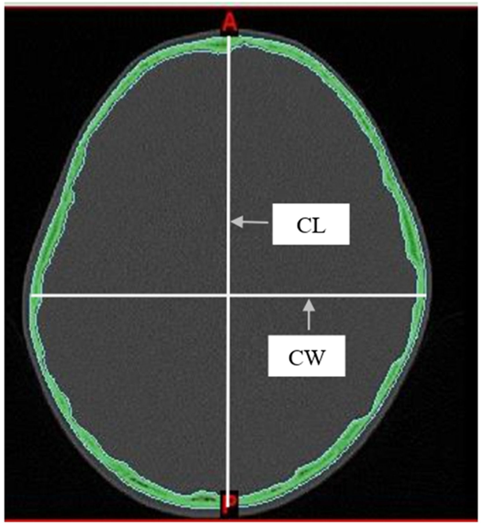 New population-specific cephalic index standards for Malaysian ...