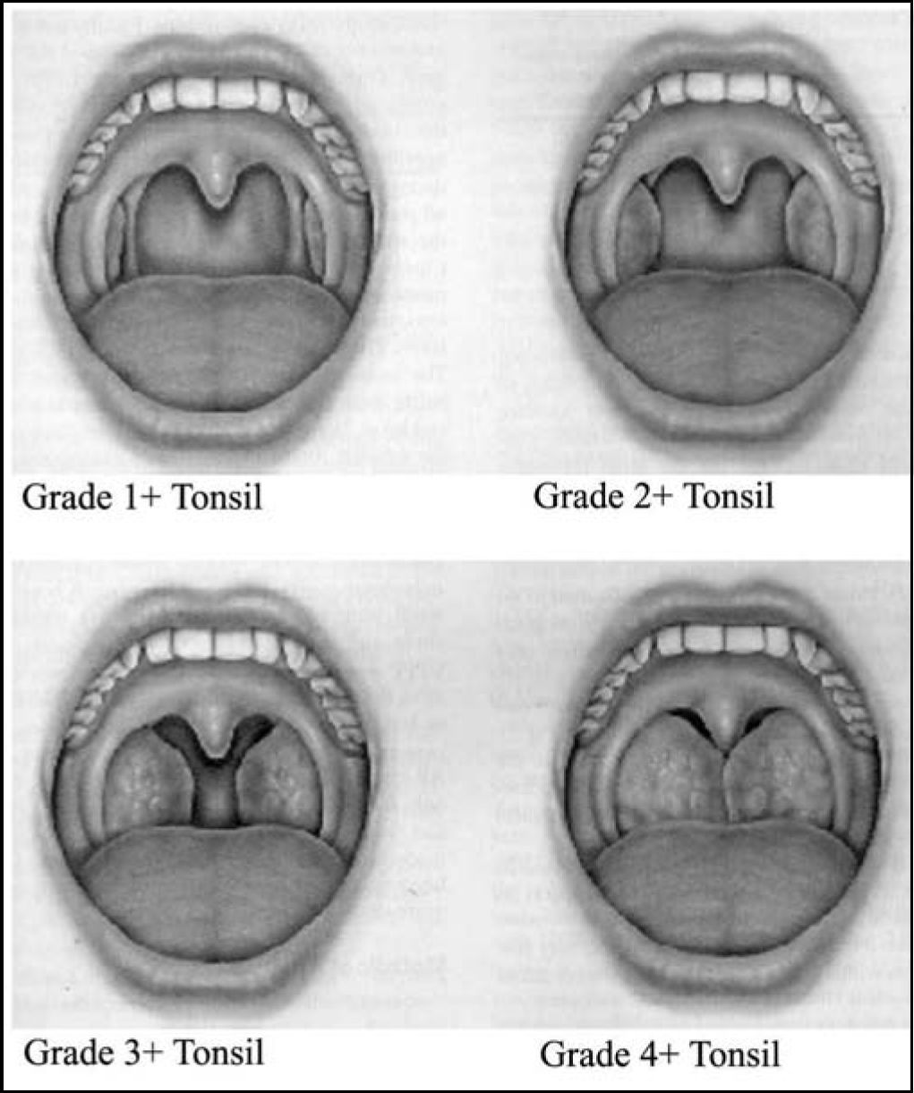 tonsils abnormal findings