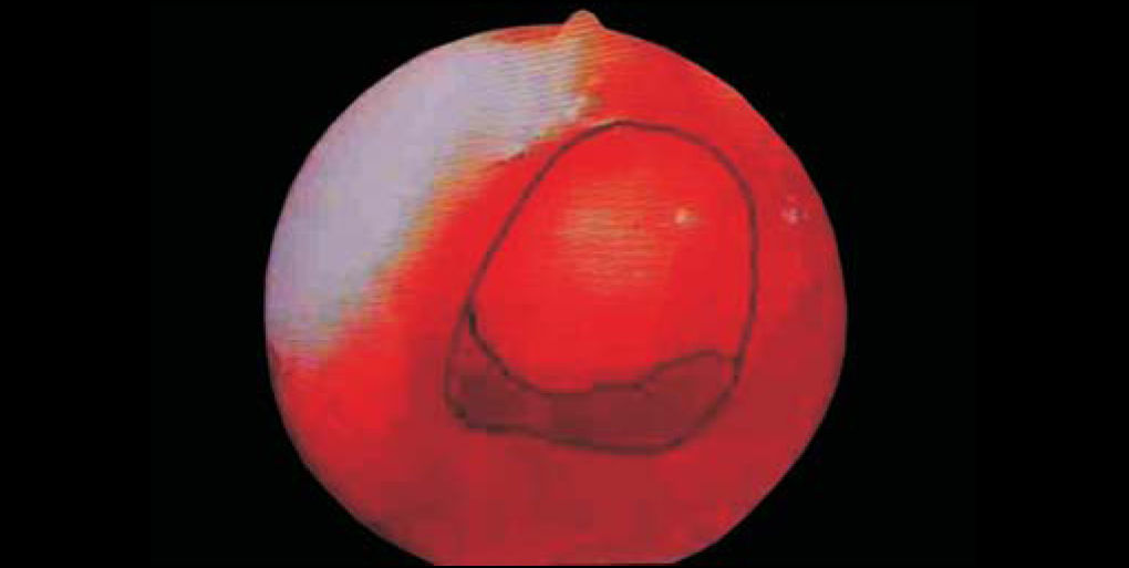 Comparison between radiological and nasopharyngolaryngoscopic ...