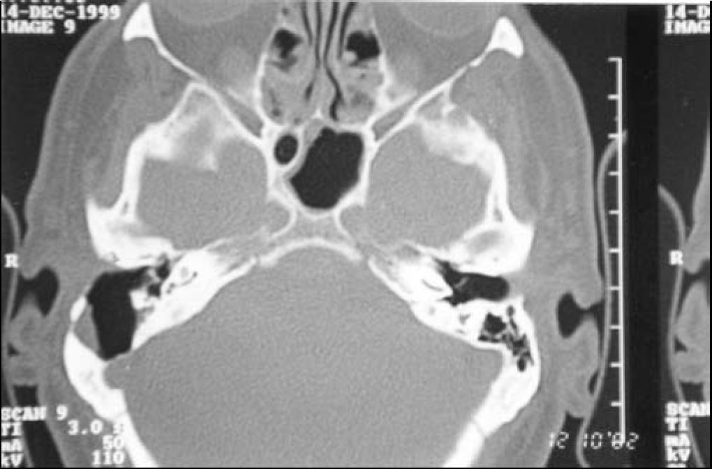 Cholesteatoma of external auditory canal: a case report | Brazilian ...