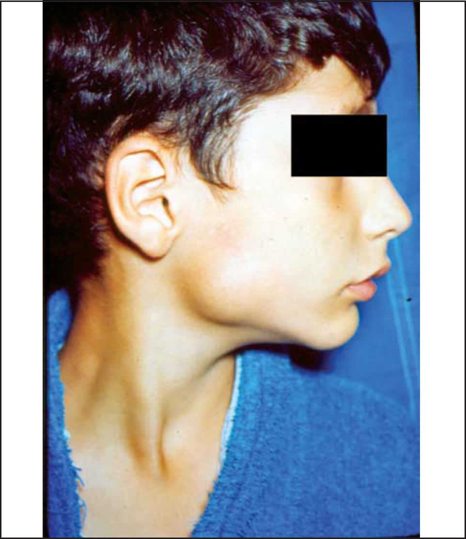 Infantile recurrent parotitis: follow up study of five cases and ...