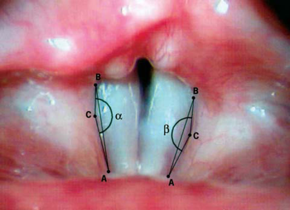 Vestibular folds configuration in vocal nodule | Brazilian Journal of ...