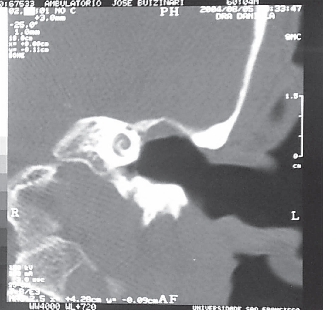 mastoidectomy types ct