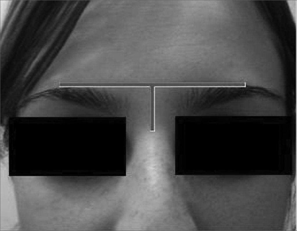 Is there a reason for performing frontal sinus trephination at 1 cm ...