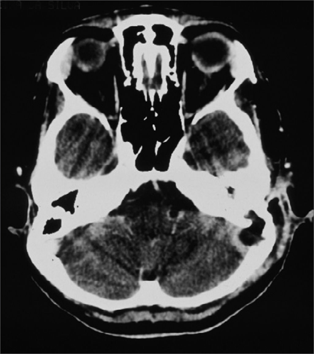 sigmoid sinusitis