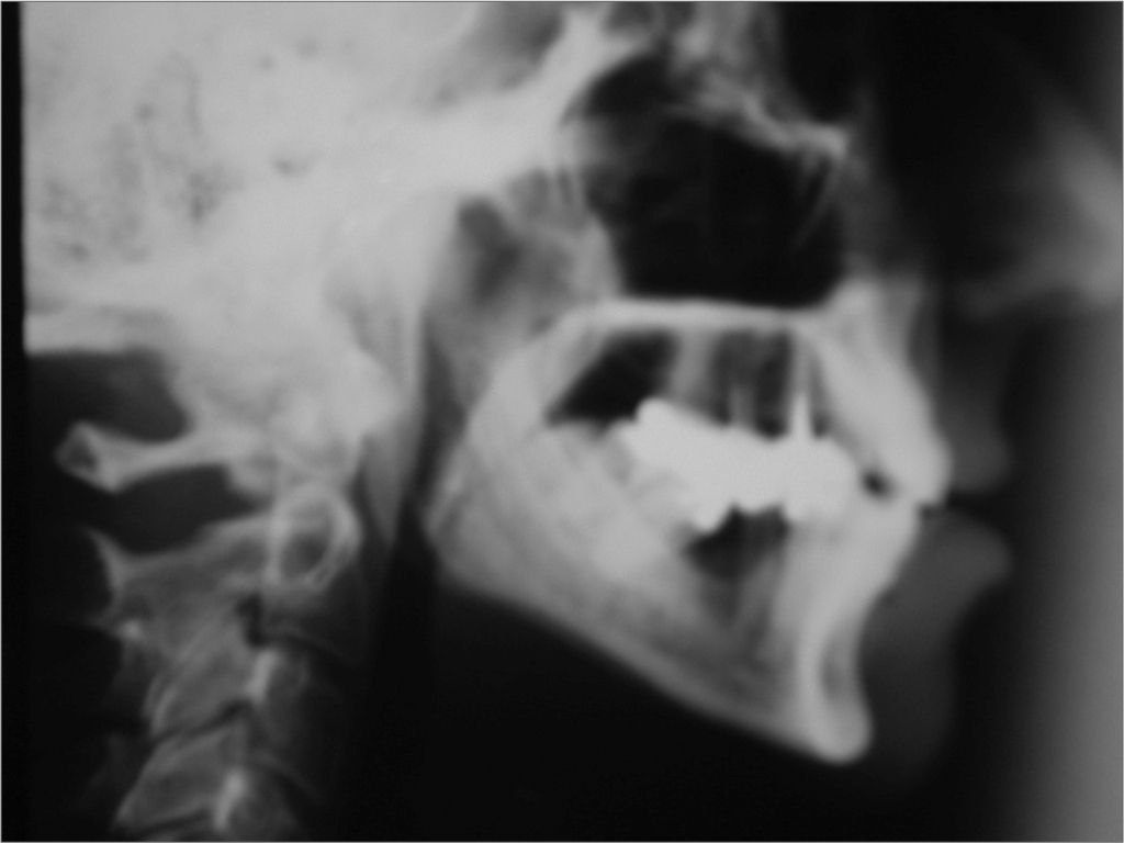 Genioplasty for genioglossus muscle advancement in patients with ...