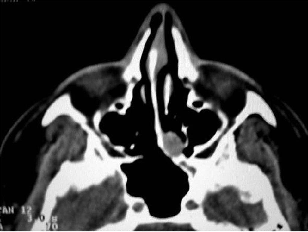 Sphenoethmoidal Recess