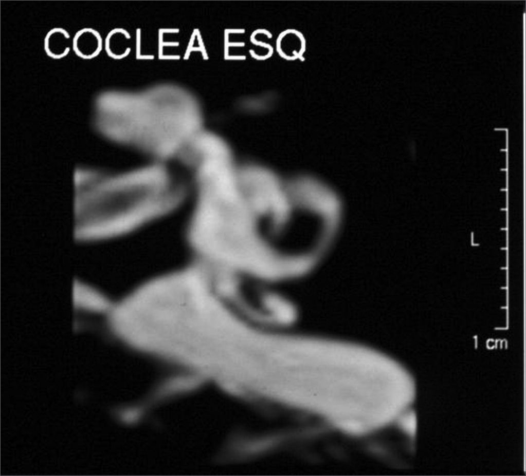 cochlear aqueduct mri