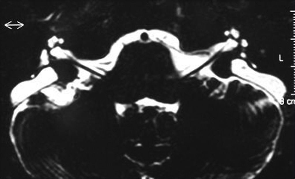 Cochlear implant and large vestibular aqueduct syndrome in children ...