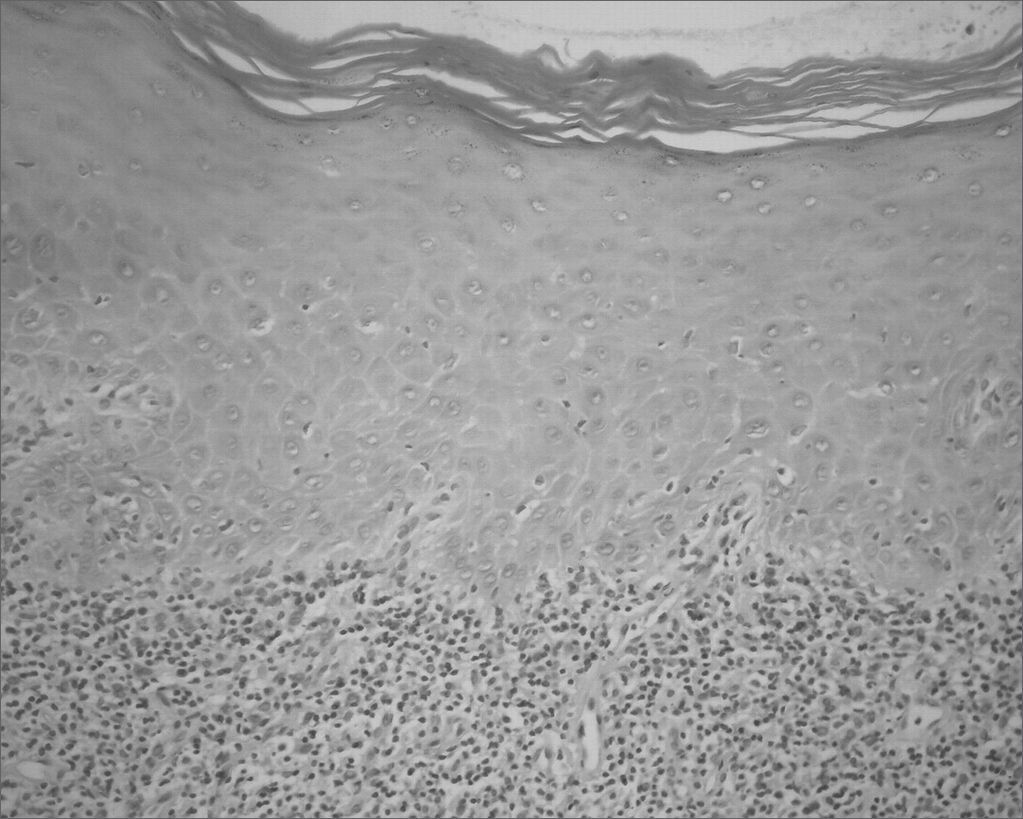 Oral lichen planus: clinical and histopathological considerations ...