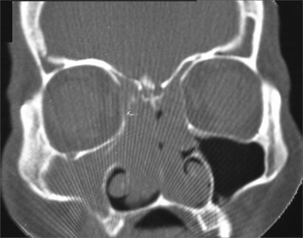 Bilateral inverted papilloma: case report and literature review ...
