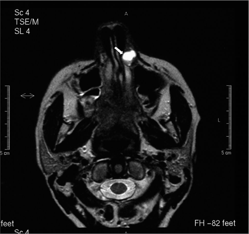 Nasolabial Cyst Radiology Non Odontogenic Hard Palate Cysts With