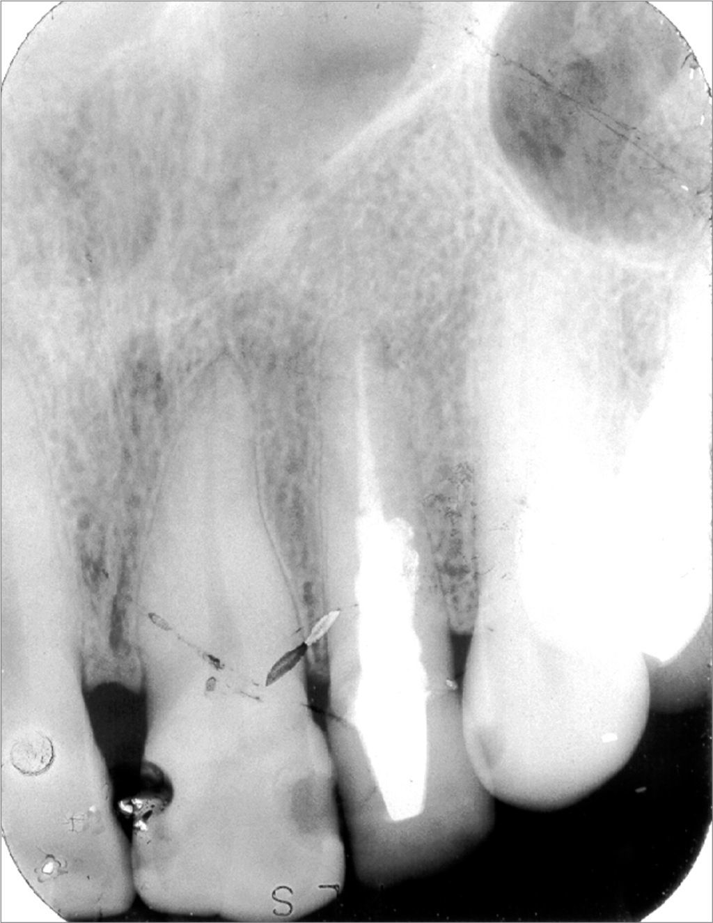 Nasolabial cyst: presentation of a clinical case with CT and MR images ...