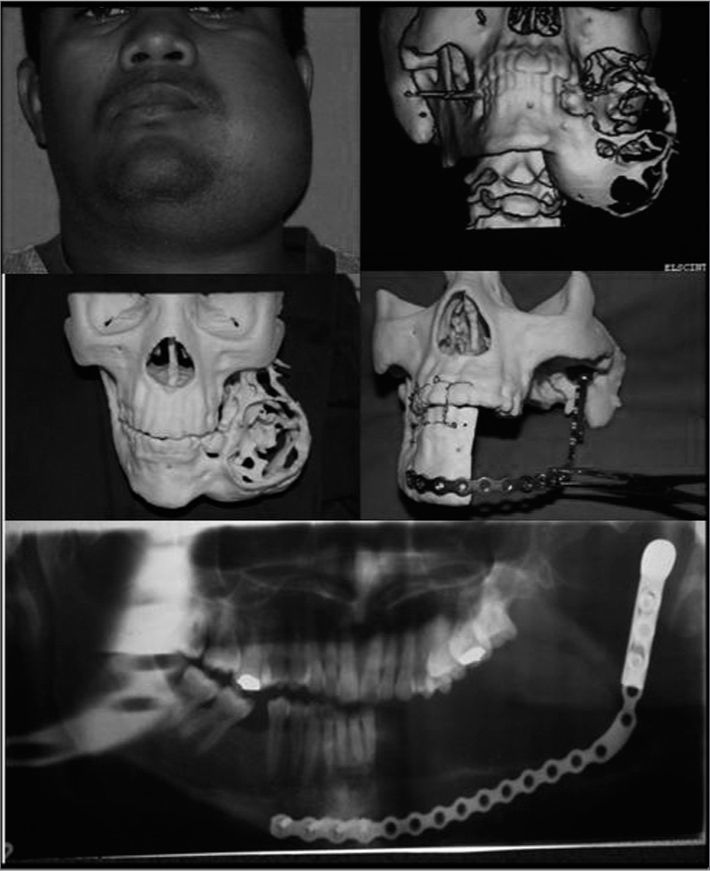 malignant ameloblastoma symptoms