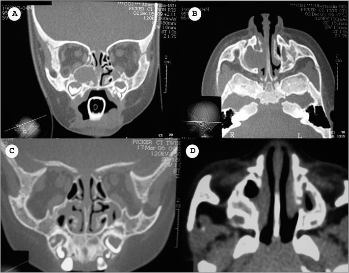 Maxillary mucocele in a 4-month infant | Brazilian Journal of ...