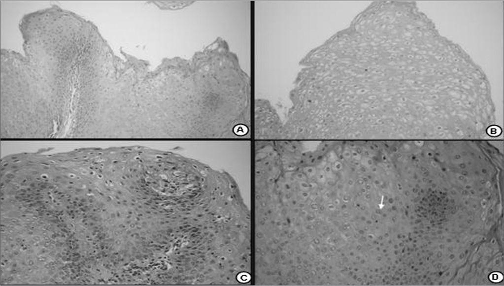 Laryngeal papillomatosis: morphological study by light and electron ...