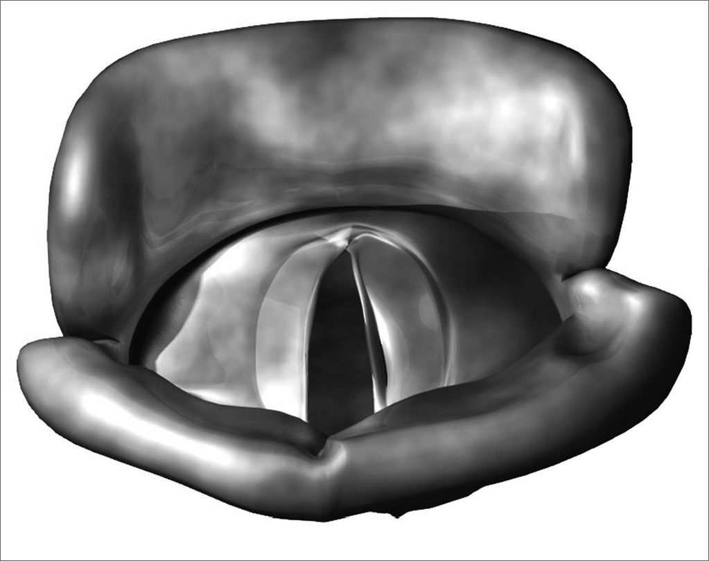Comparison between telelaryngoscopy and suspension laryngoscopy in the ...