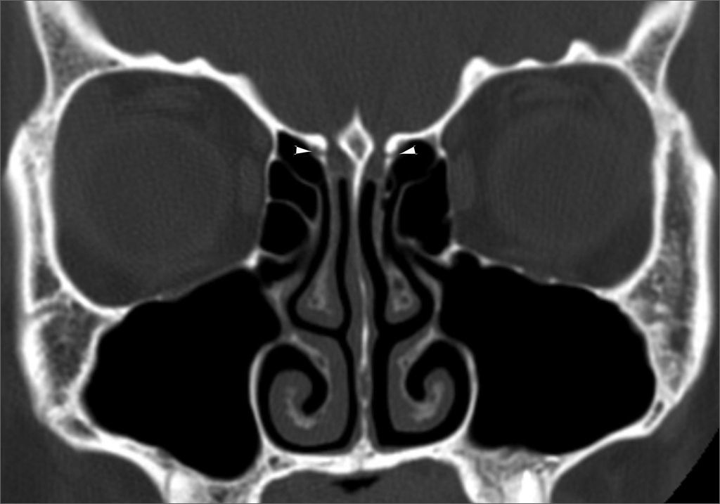 Anterior Ethmoidal Artery Evaluation on Coronal CT Scans | Brazilian ...