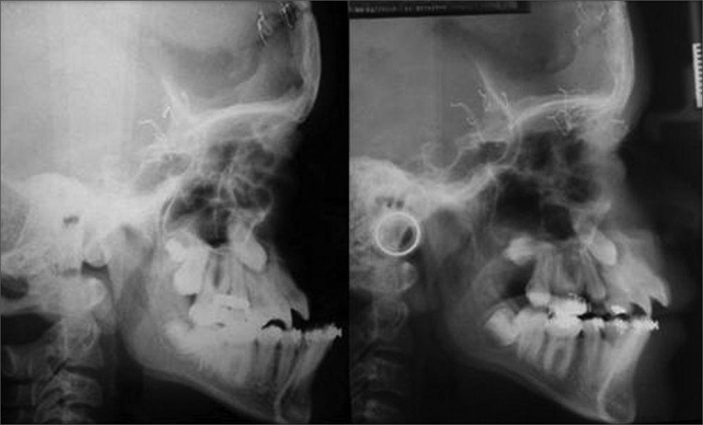 Evaluation of cephalometric points in midface bone lengthening with the ...
