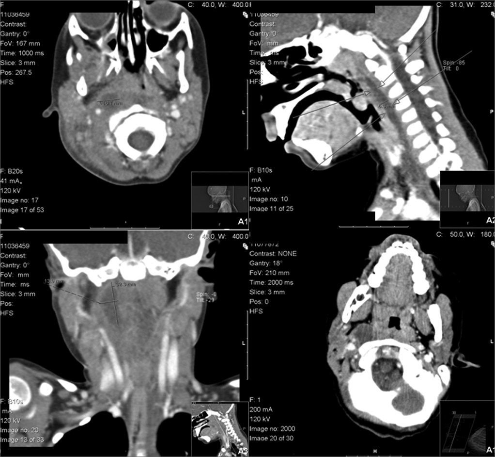 Parapharyngeal abscess in children - five year retrospective study ...