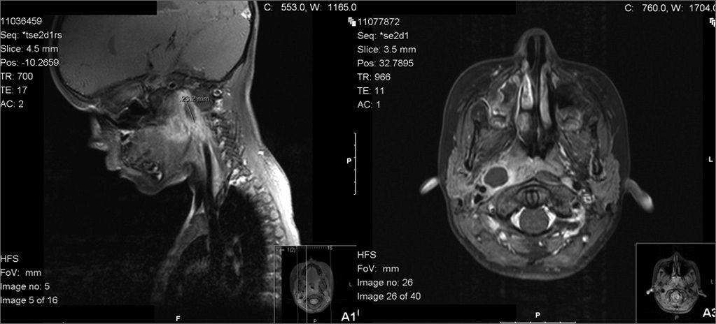 Parapharyngeal Abscess