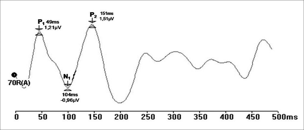 Auditory Evoked Potentials