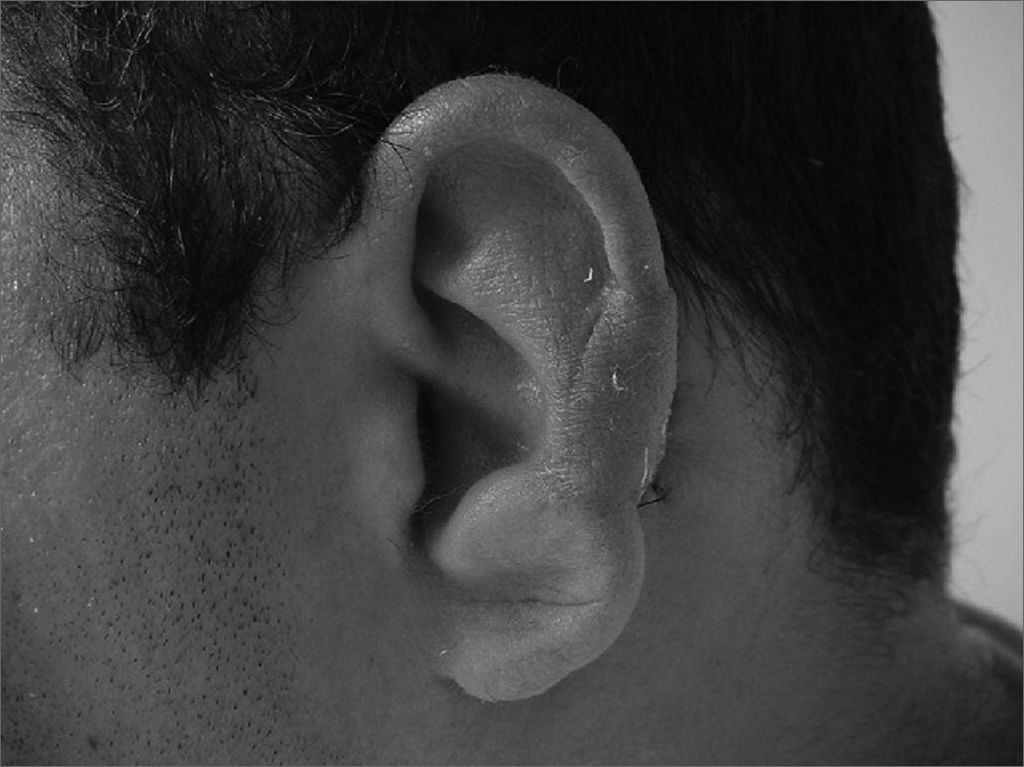 Partial reconstruction of the external ear after a trauma-simple and ...