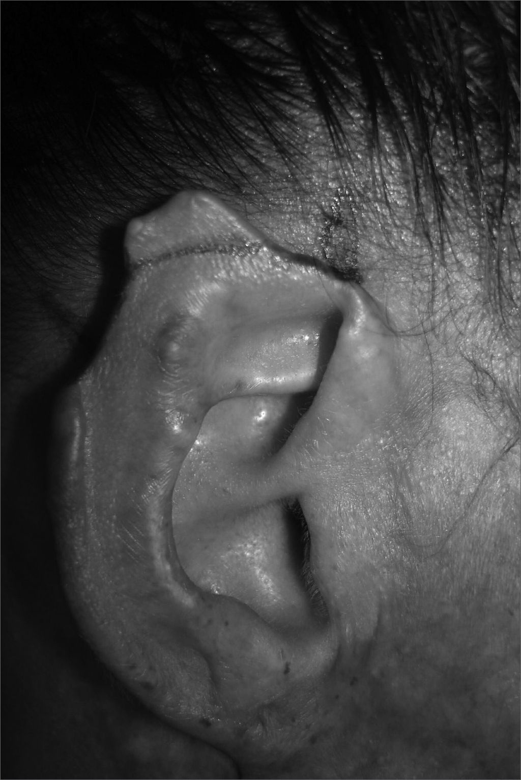 Partial reconstruction of the external ear after a trauma-simple and ...