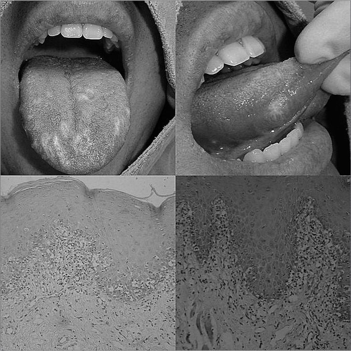 Graft versus host disease diagnosis through biopsy of the oral mucosa ...