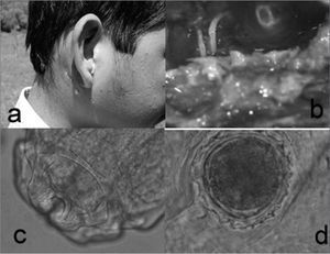 Otomastoidititis with right retroauricular fistula by Lagochilascaris ...