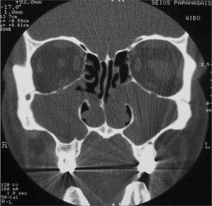 maxillary antrum polyp