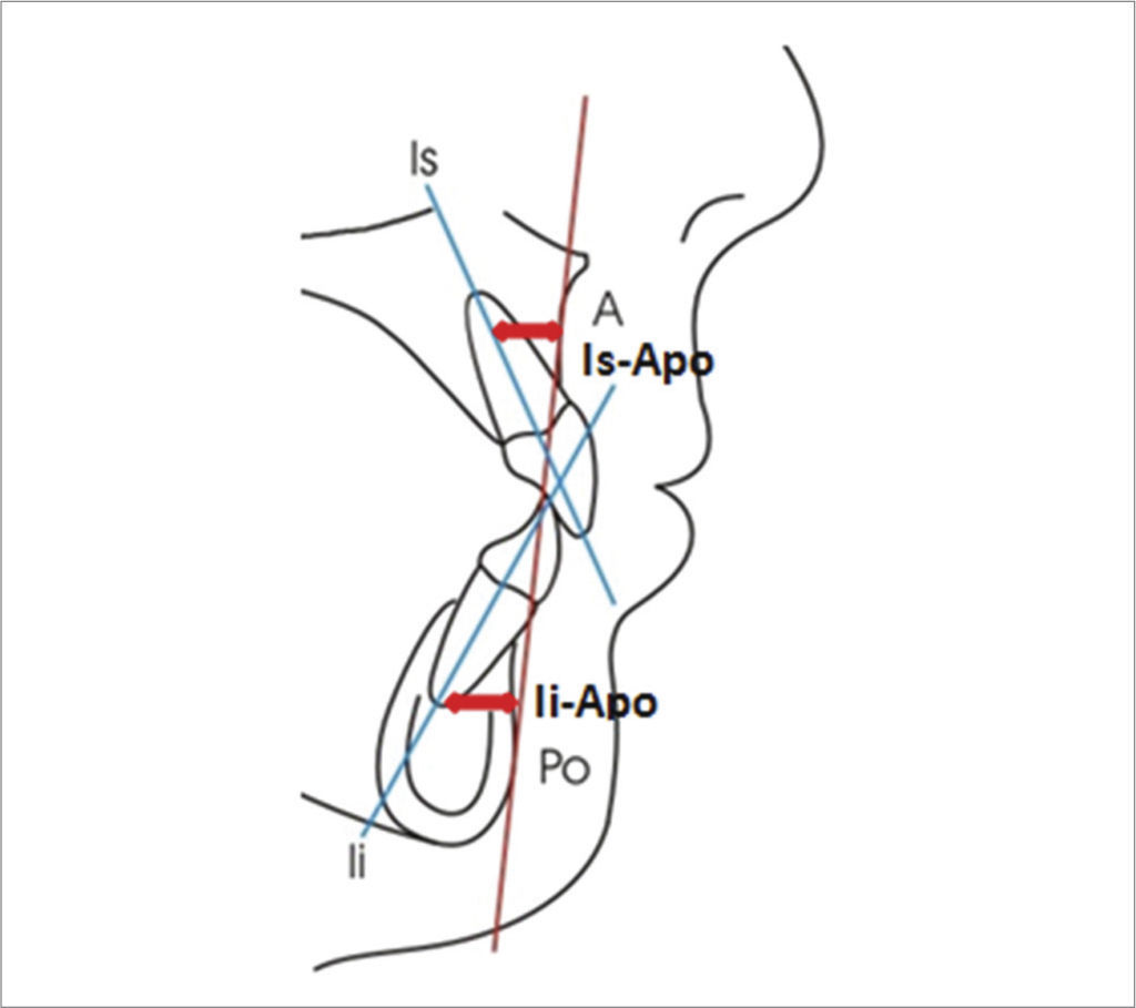 Adenotonsillectomy in facial growing patients: spontaneous dental ...