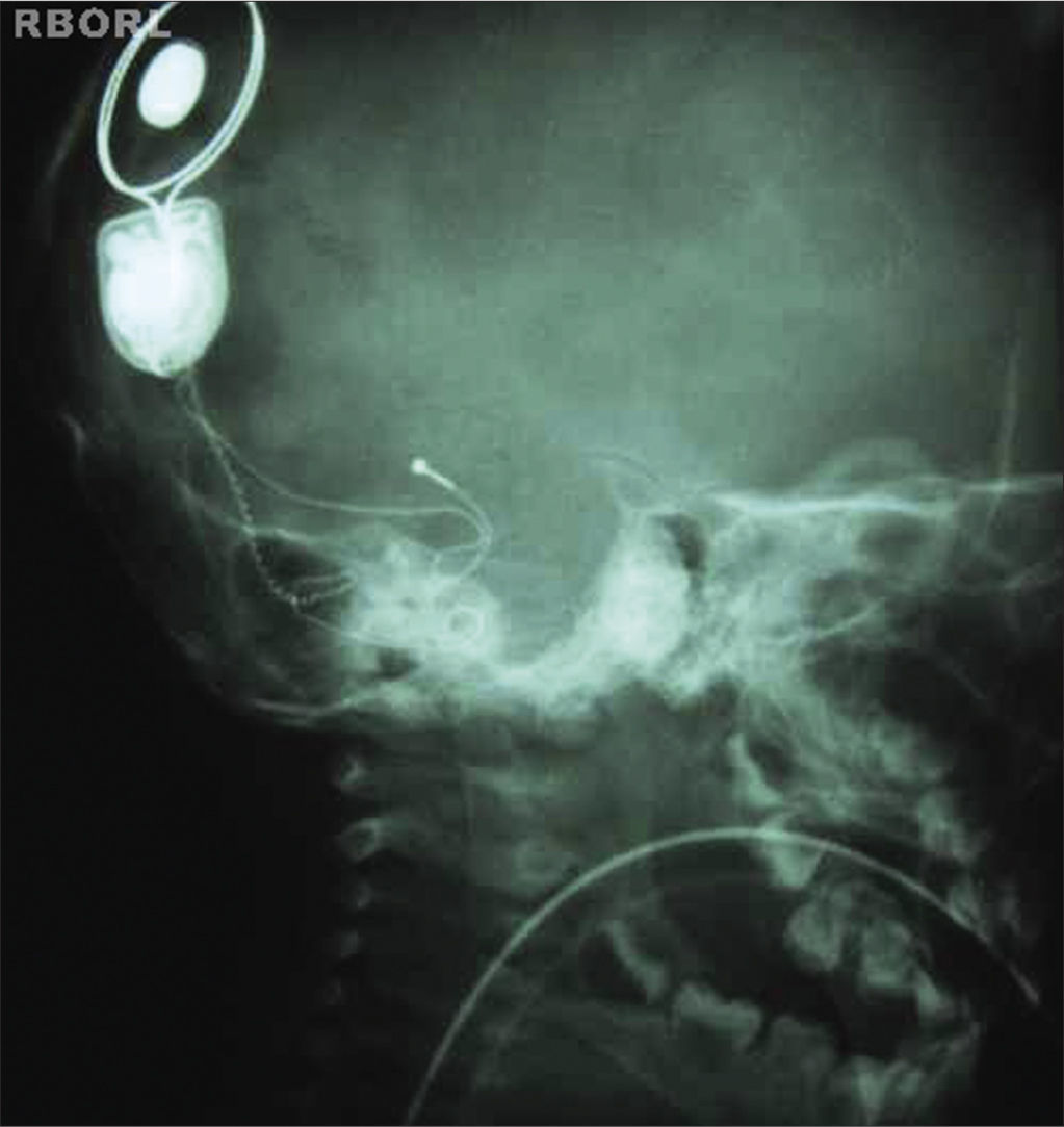 mastoiditis x ray position