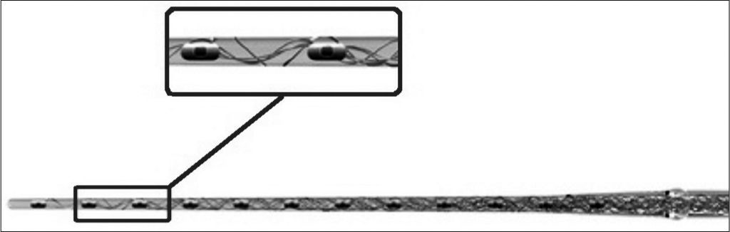 Electro acoustic stimulation of the auditory system: UNICAMP's surgical ...