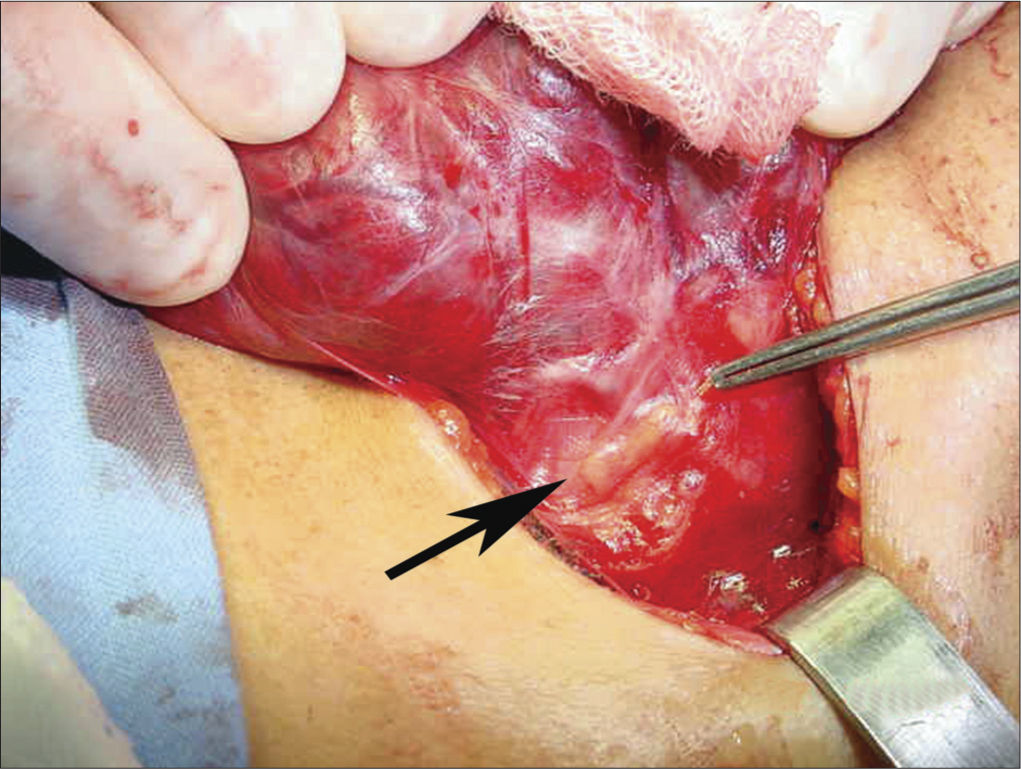 parathyroidectomy operation