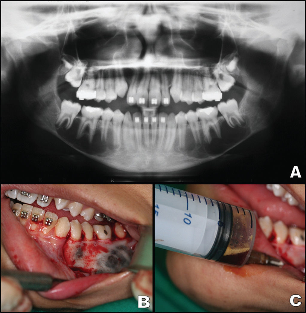 Traumatic bone cyst of the mandible: a review of 26 cases | Brazilian ...