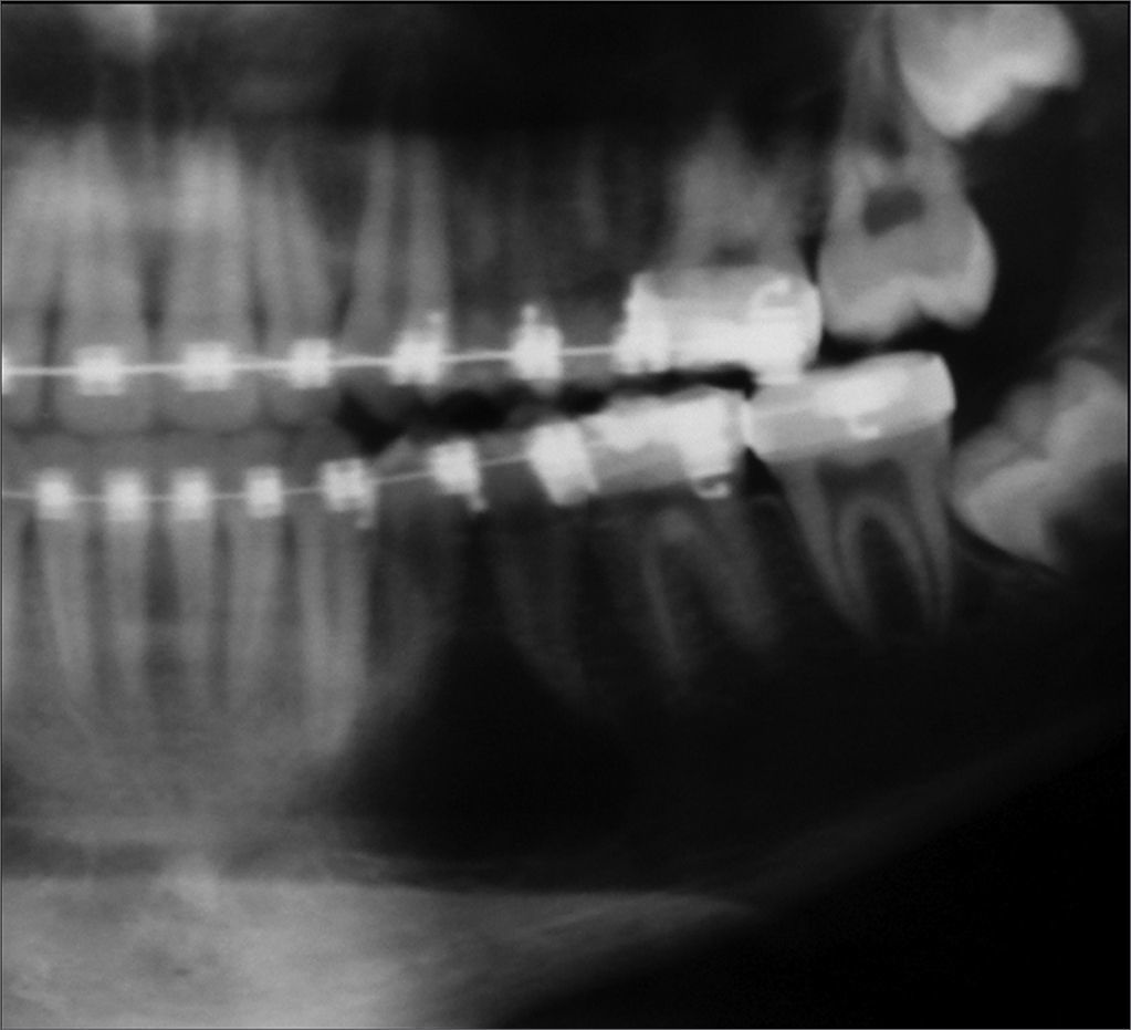 Traumatic bone cyst of the mandible: a review of 26 cases | Brazilian ...