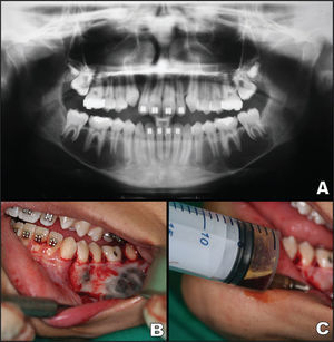 simple bone cyst jaw