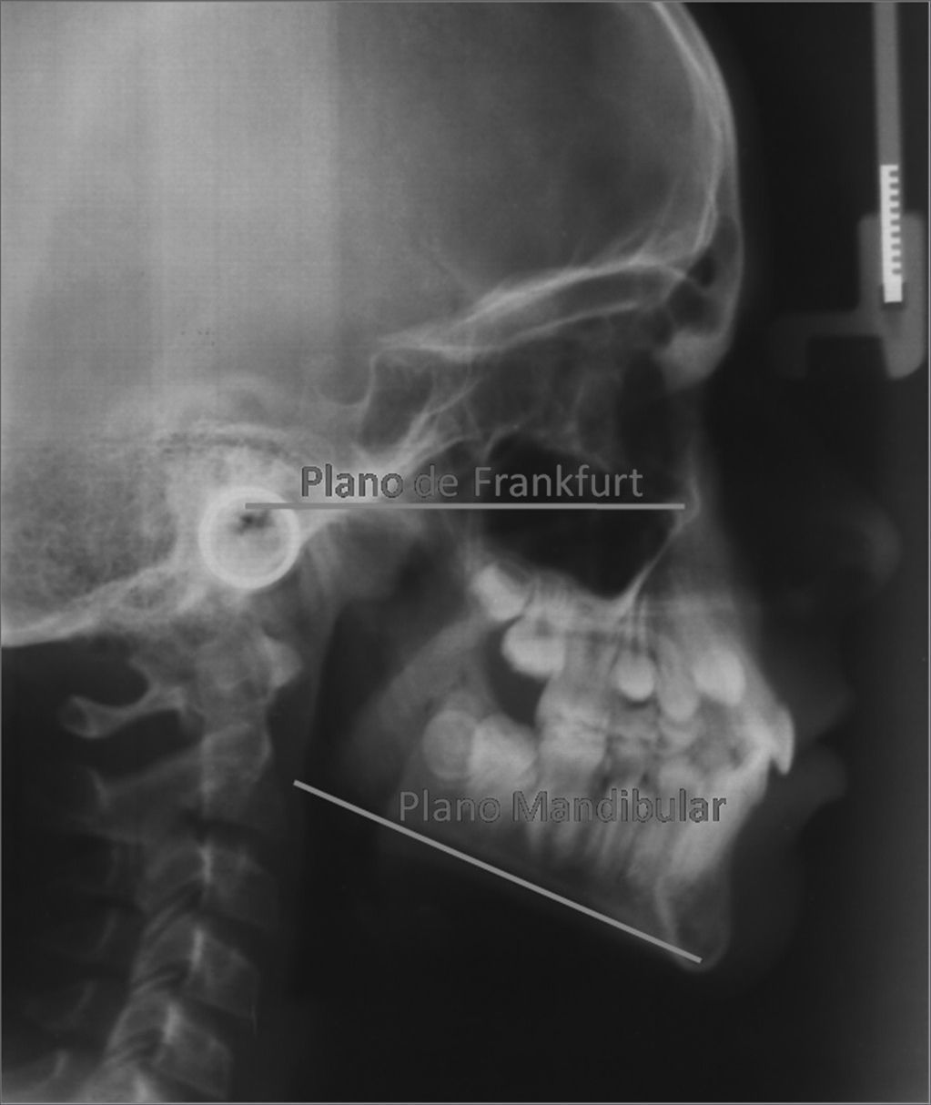 Study of craniofacial alterations and of the importance of the rapid ...
