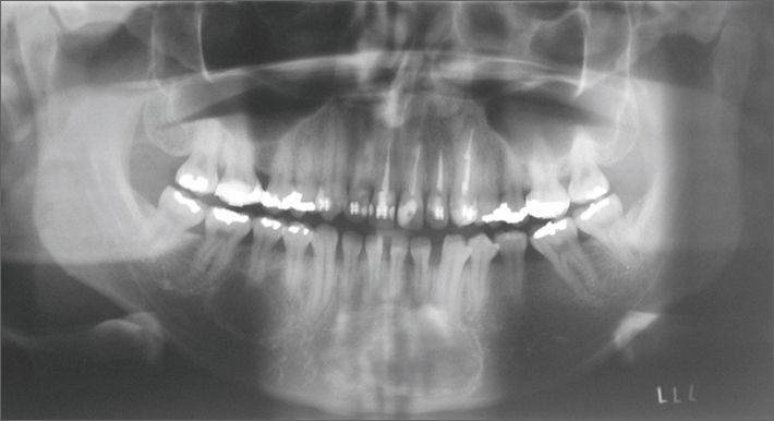 Mandibular simple bone cysts: a rare case of bilateral occurrence ...