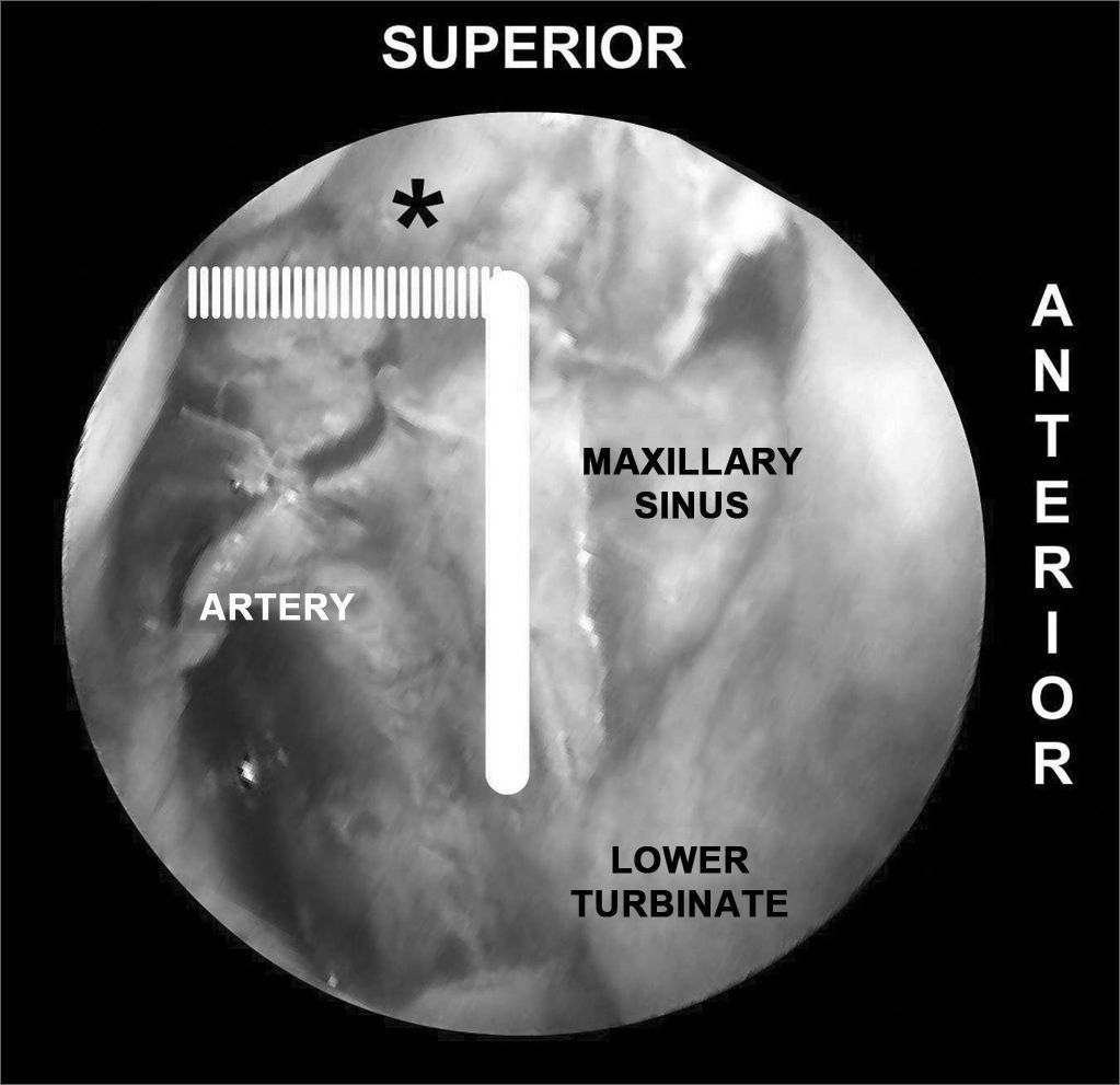 The sphenopalatine artery: a surgical challenge in epistaxis ...