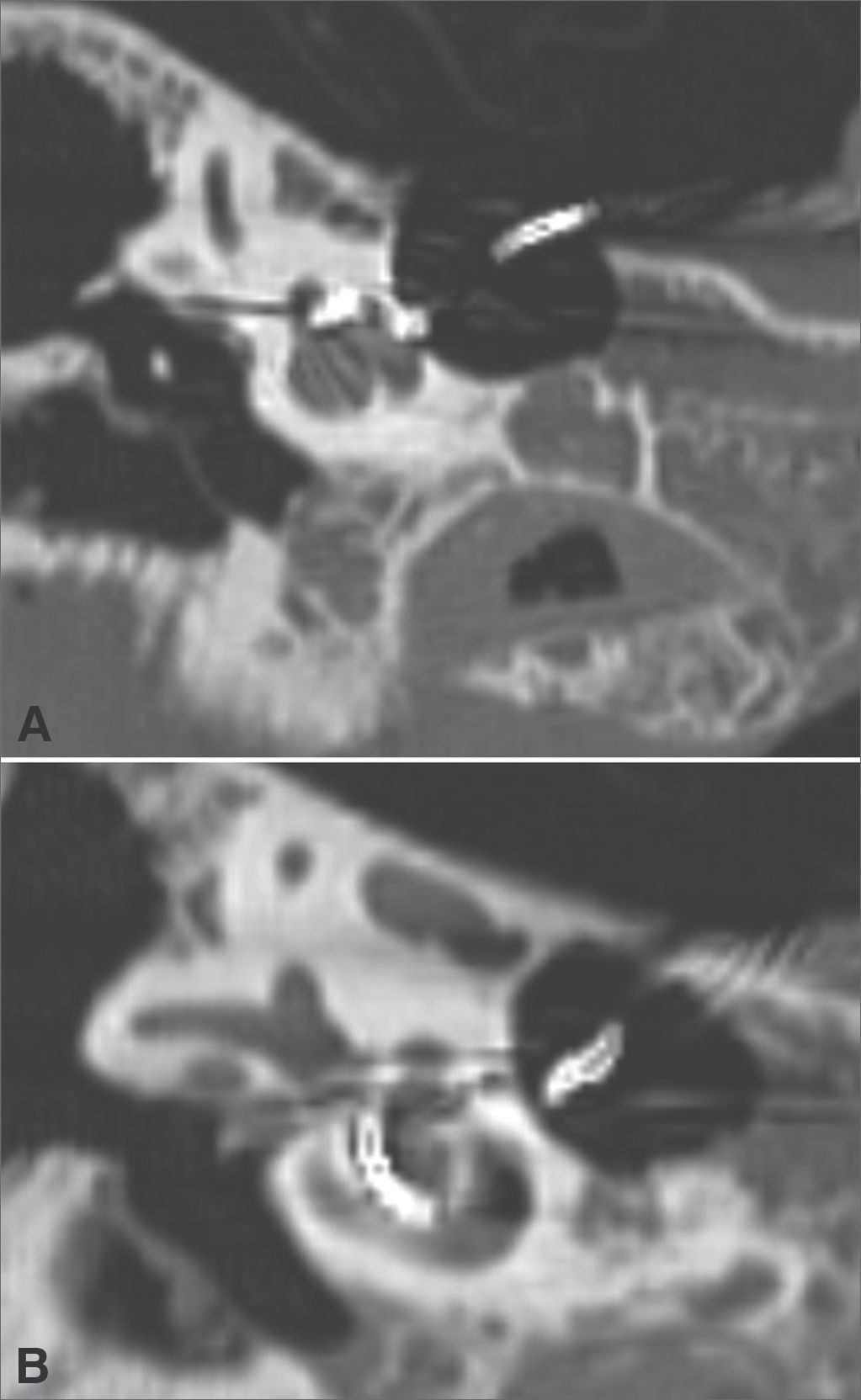 Cochlear implantation trough the middle cranial fossa: a novel approach ...