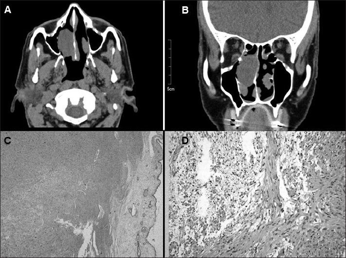 nasal septum bones ct