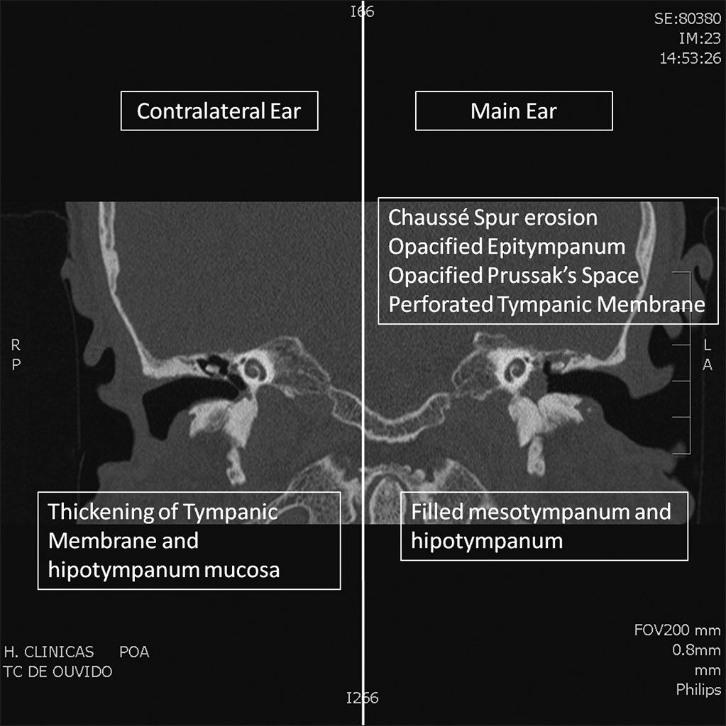 otitis interna ct