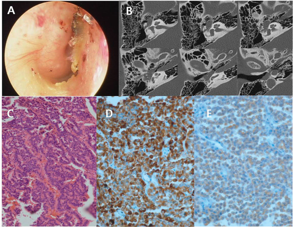 Neuroendocrine adenoma of the middle ear confused with congenital ...