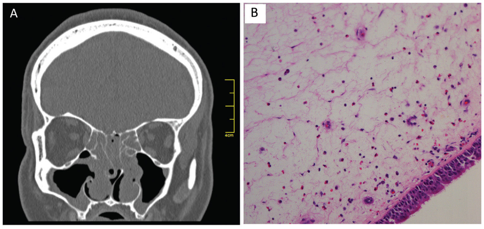 Bilateral antrochoanal polyp: case report* | Brazilian Journal of ...