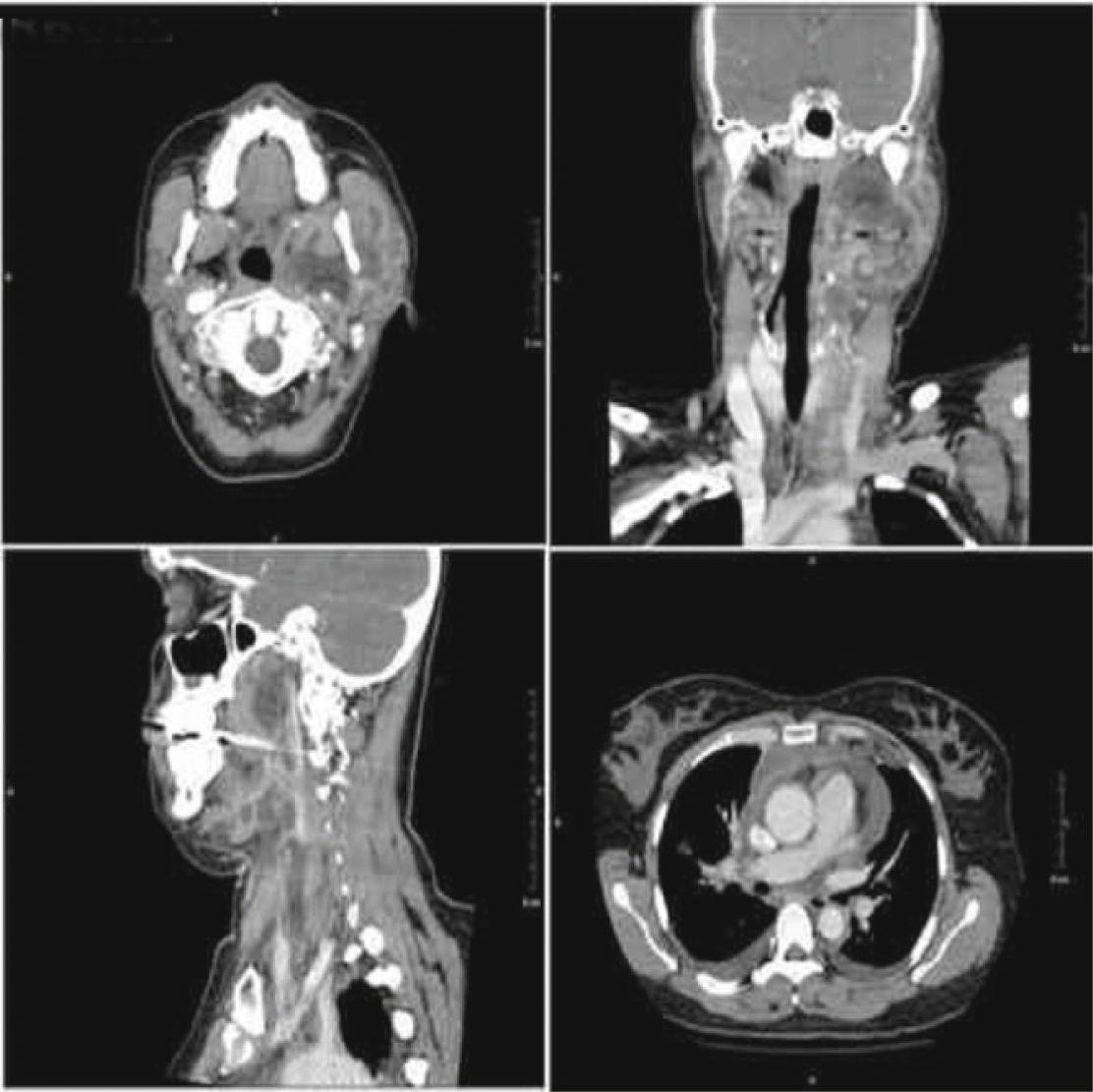parotid space abscess radiology